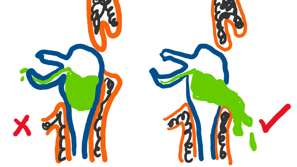 External Dacryocystorhinostomy (DCR) Surgery Steps - INSIGHT OPHTHALMOLOGY