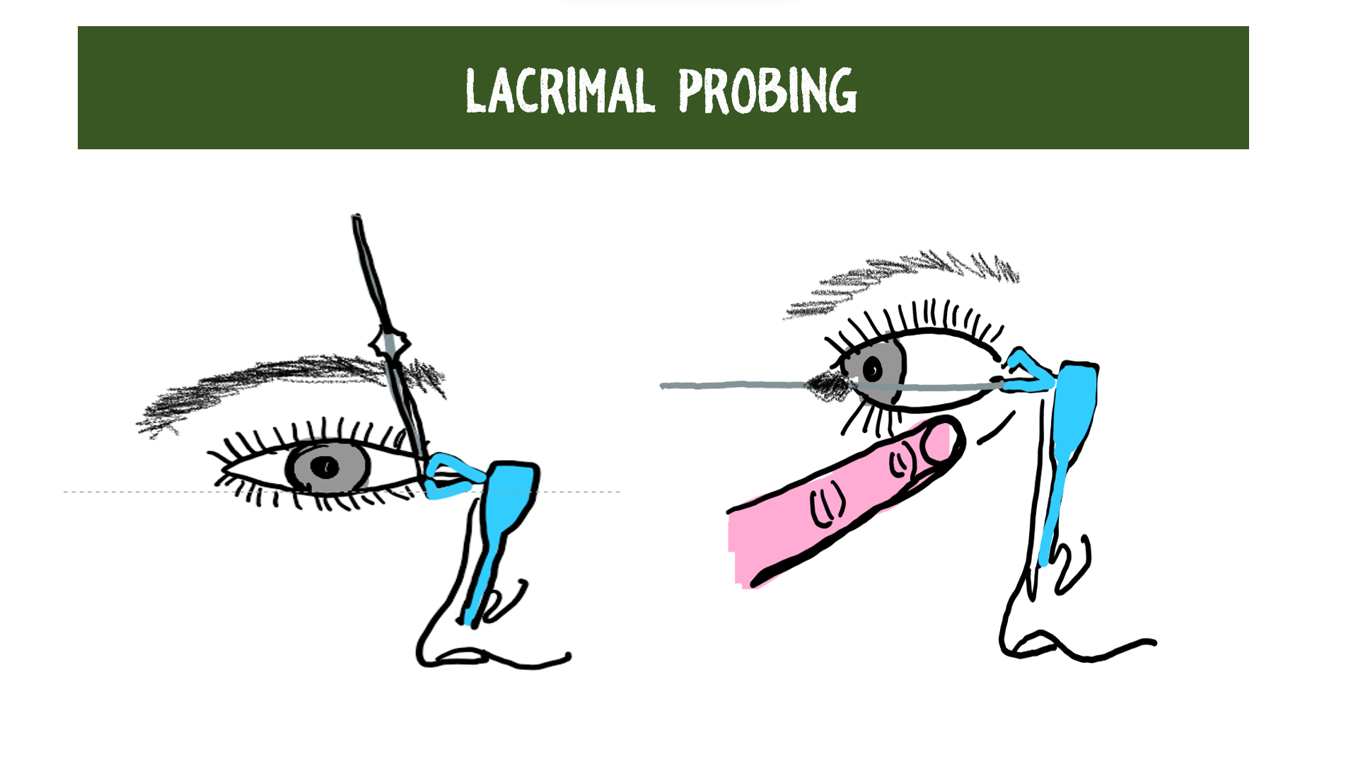 Lacrimal Syringing and Probing Made Incredibly Easy! - INSIGHT ...
