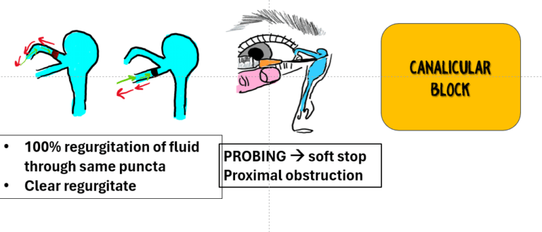 Lacrimal Syringing and Probing Made Incredibly Easy! - INSIGHT ...
