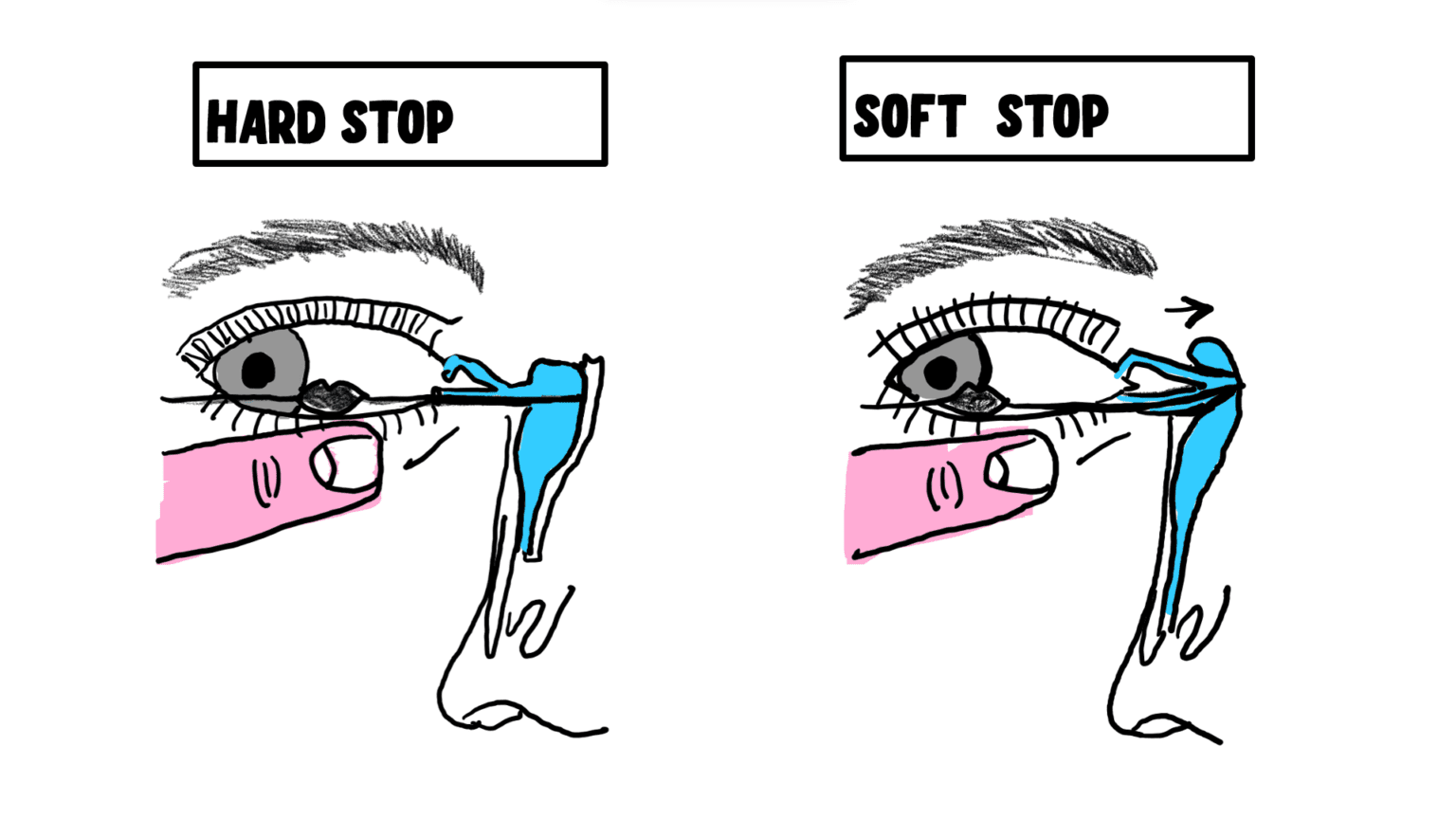 Lacrimal Syringing and Probing Made Incredibly Easy! - INSIGHT ...
