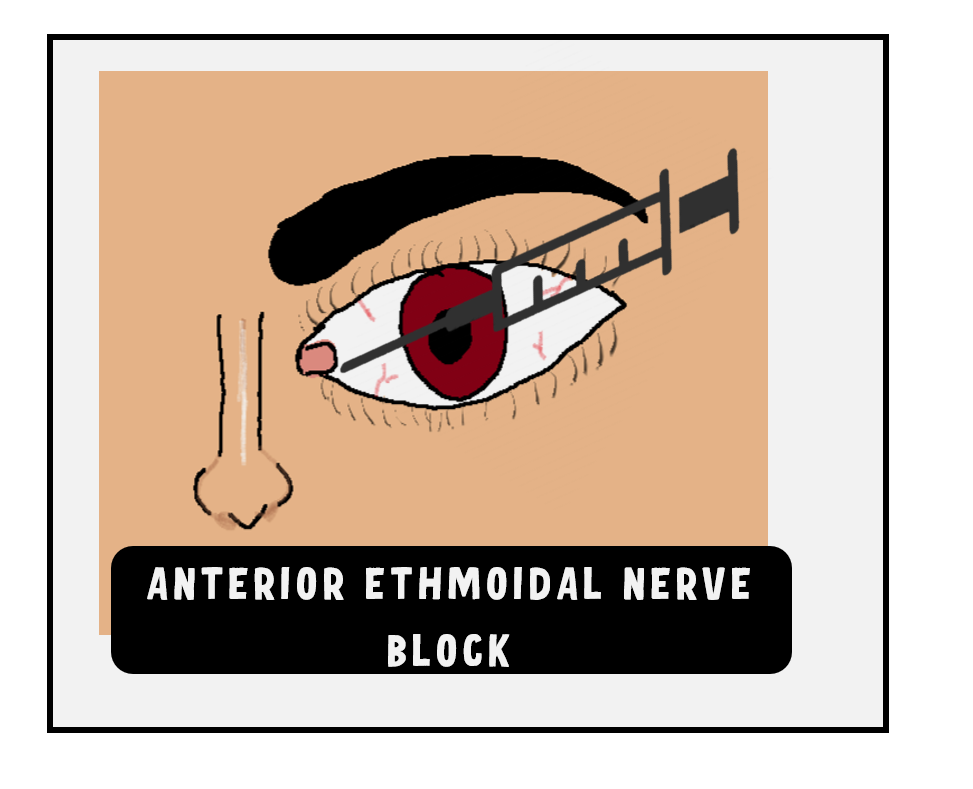 Nerve Blocks for Lacrimal Sac Surgeries: A Comprehensive Guide ...