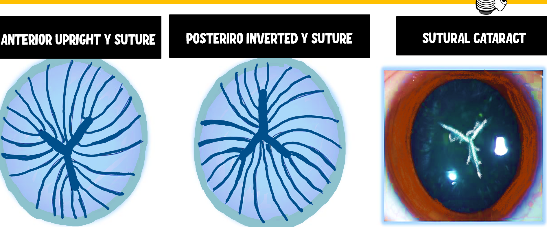 Anatomy of Lens Made Easy - INSIGHT OPHTHALMOLOGY