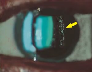 Intermediate Uveitis: Understanding Symptoms, Signs and Complications ...