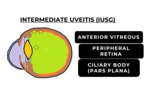 Intermediate Uveitis: Understanding Symptoms, Signs and Complications - INSIGHT OPHTHALMOLOGY