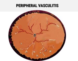 Intermediate Uveitis: Understanding Symptoms, Signs and Complications ...